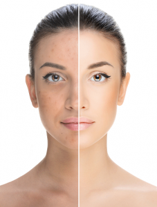 Laser Genesis Skin Therapy | Abramson Facial Plastic Surgery