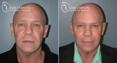 Facelift Before and After Photos | Abramson Facial Plastic Surgery