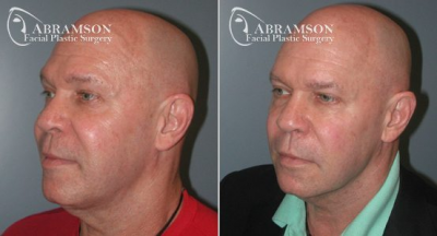 Facelift Before and After Photos | Abramson Facial Plastic Surgery