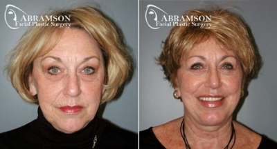 Neck Lift Photos show how excess skin and fat can be removed.