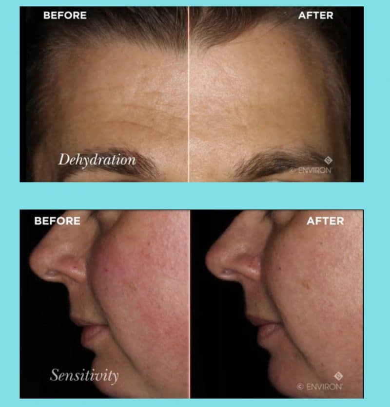 Environ Ionzyme DF Facial - Abramson Facial Plastic Surgery