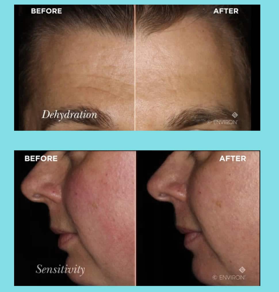 Environ Ionzyme DF Facial - Abramson Facial Plastic Surgery