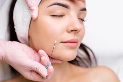 Nova Threads: The New, Non-Surgical Facelift | Abramson Facial Plastic ...