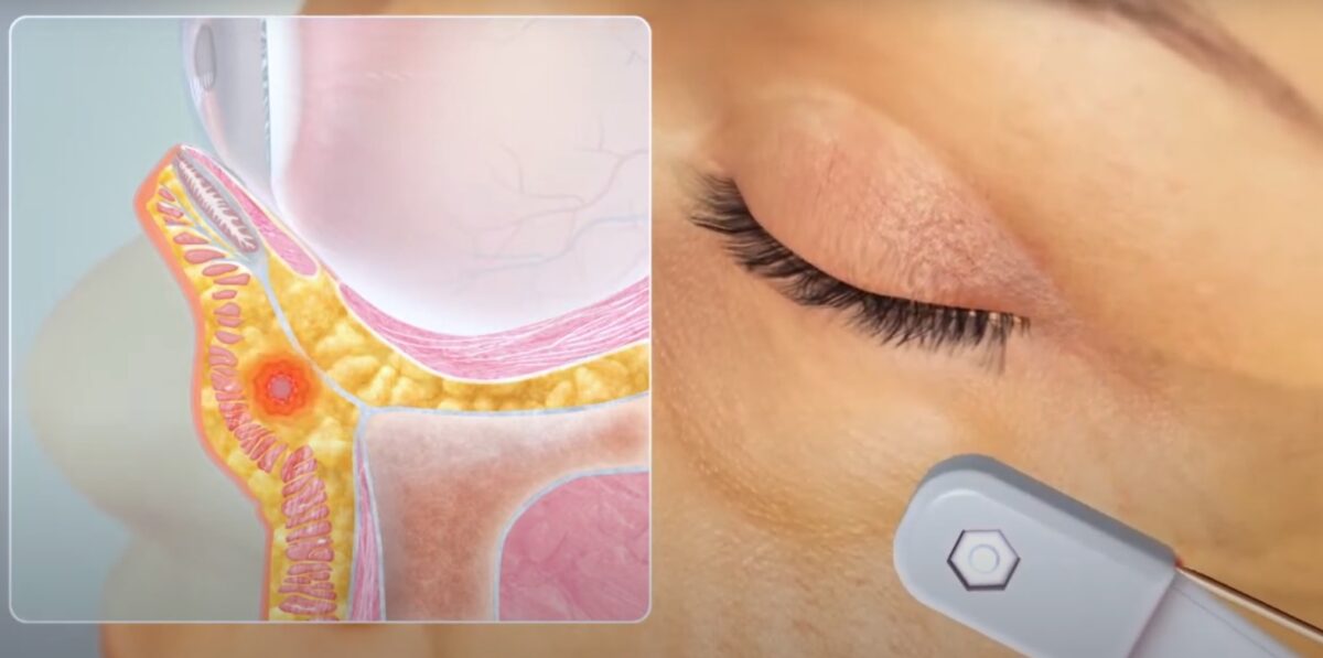 AccuTite Facial Rejuvenation | Abramson Facial Plastic Surgery