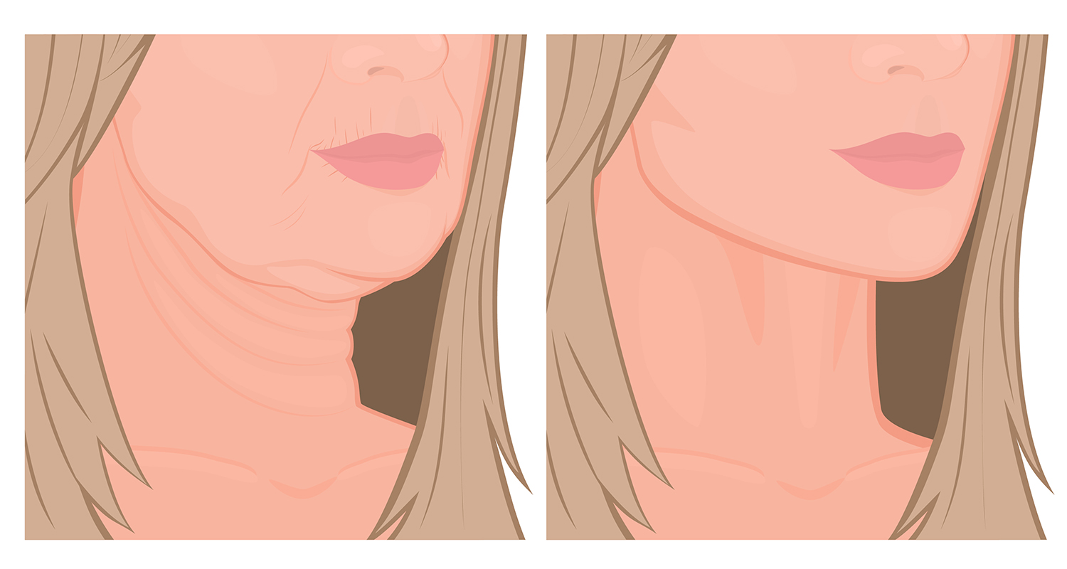 Facelift | Abramson Facial Plastic Surgery